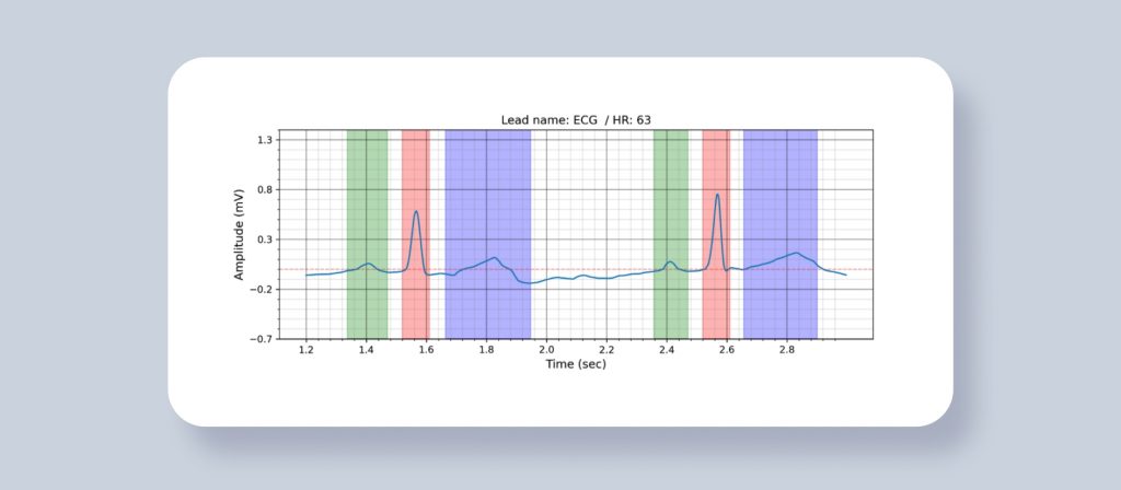 HRV Analysis & Atrial Fibrillation Detection using ML