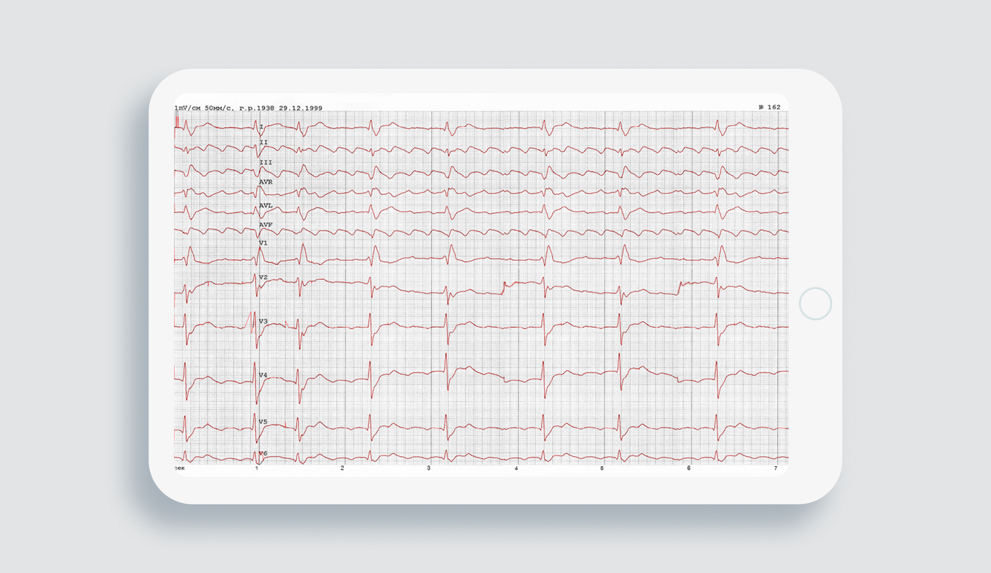 Computer Vision System for ECG | Computer Vision in Medical Imaging