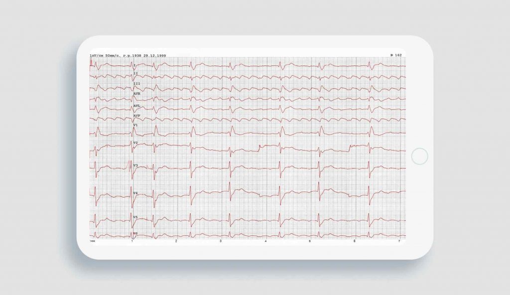 Computer Vision System for ECG | Computer Vision in Medical Imaging ...